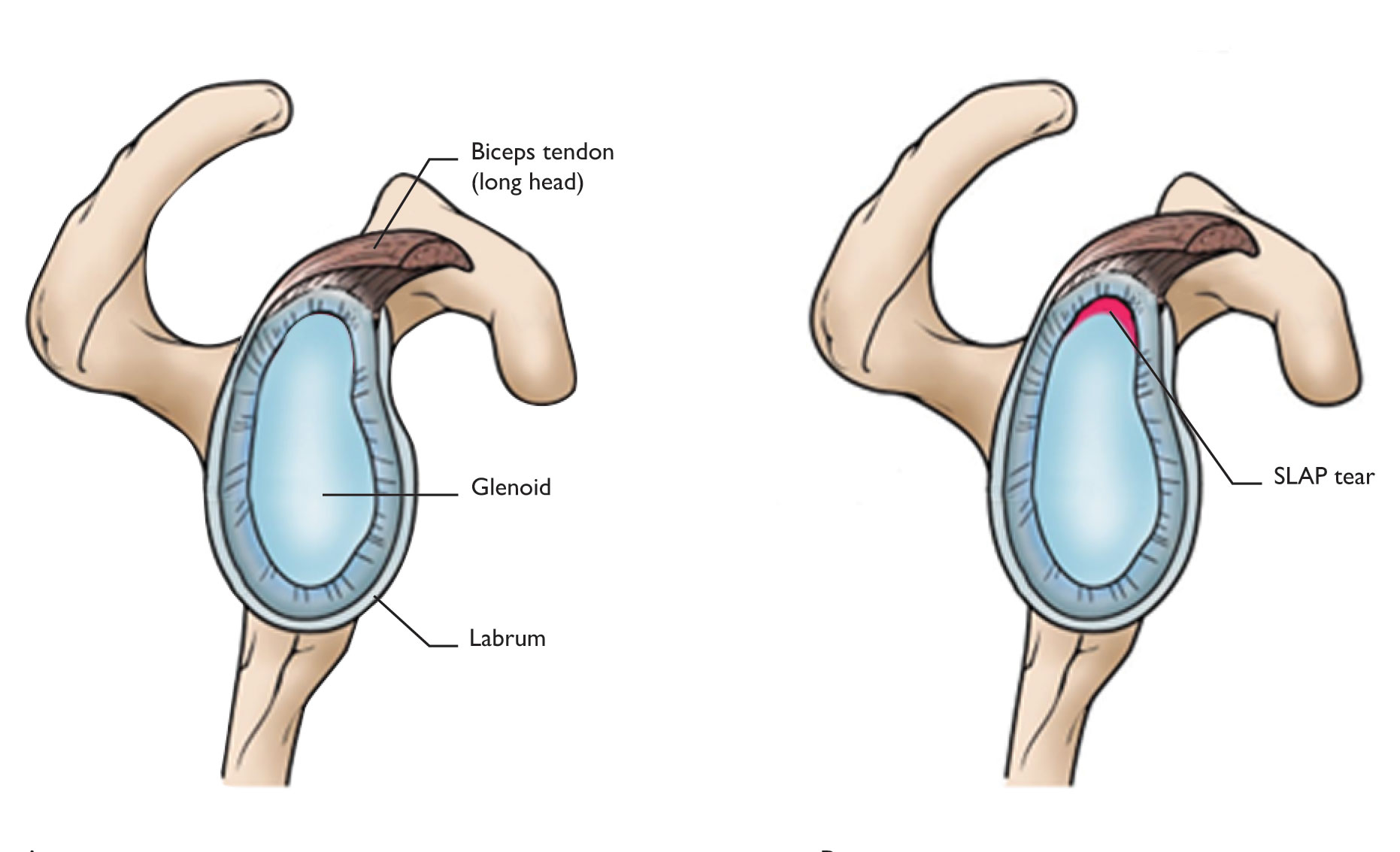 SLAP Tear Repair Recovery: What to Expect and How Physiotherapy Helps